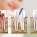 MI HIJO TIENE CARIES, ¿QUÉ HAGO? - Clinica Dental Fabián López
