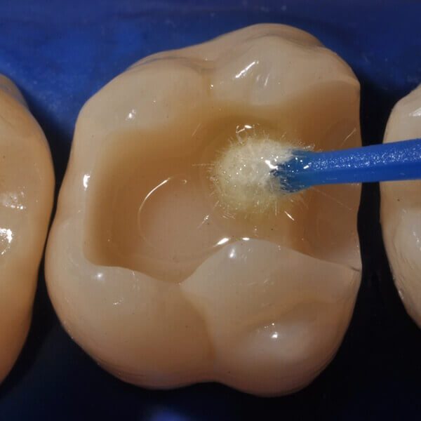 ¿QUÉ ES UN EMPASTE DENTAL? - Clinica Dental Fabián López