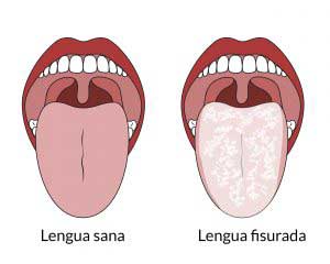LENGUA GEOGRÁFICA - Clinica Dental Fabián López